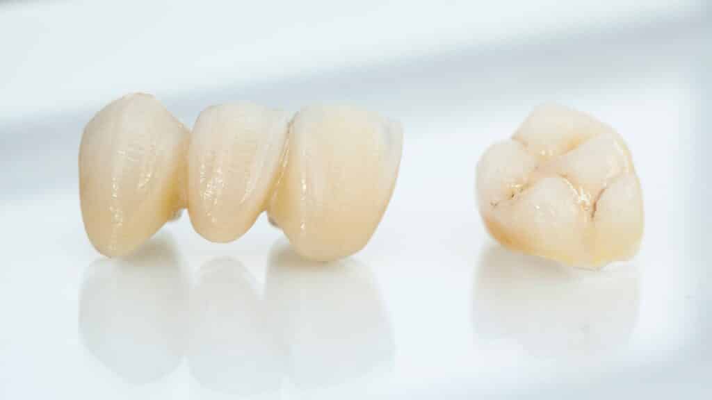 Dental Crowns & Bridges – Al Itqan Dental Clinic